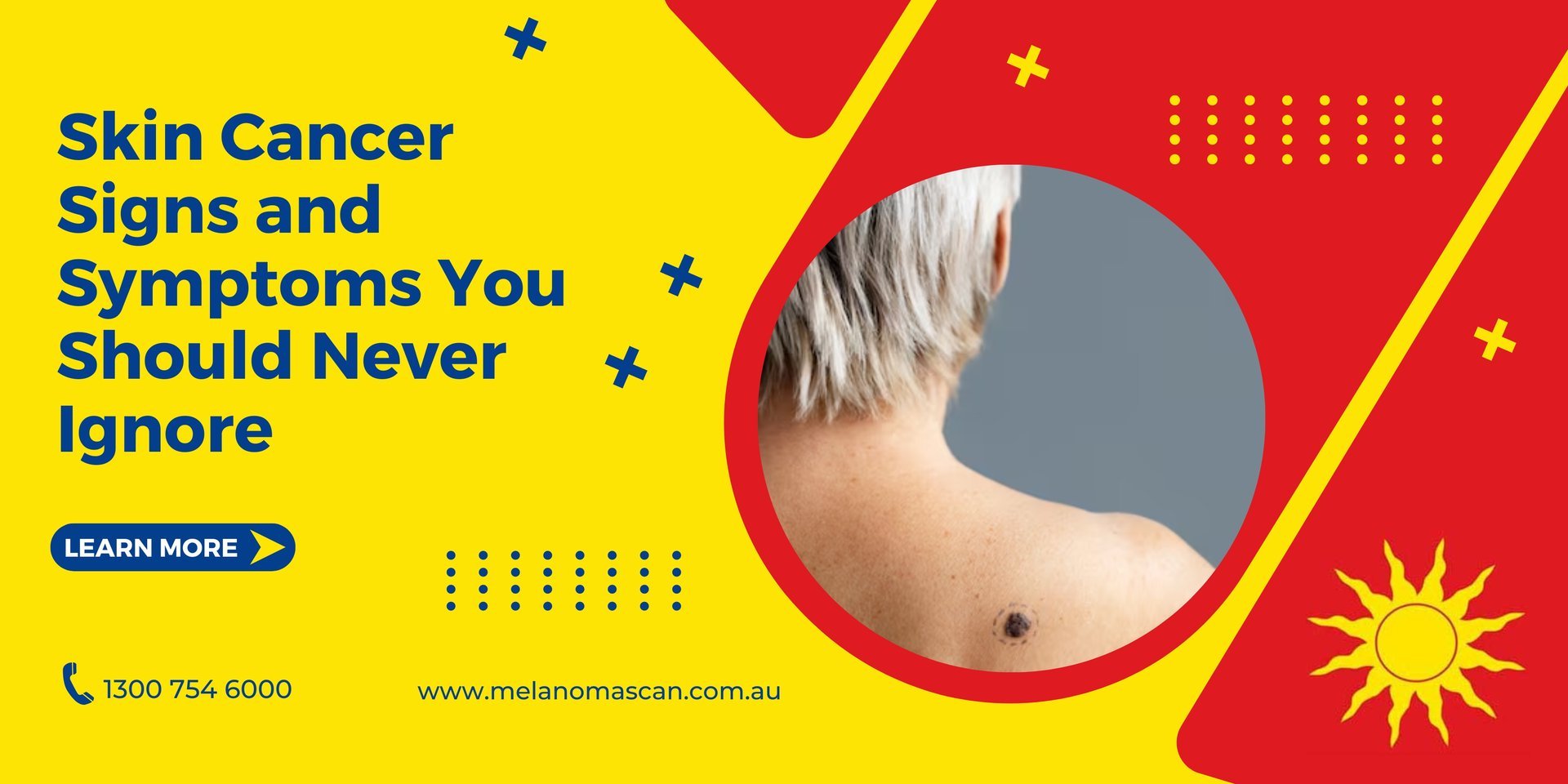 Skin Cancer Signs and Symptoms - Melanoma Scan